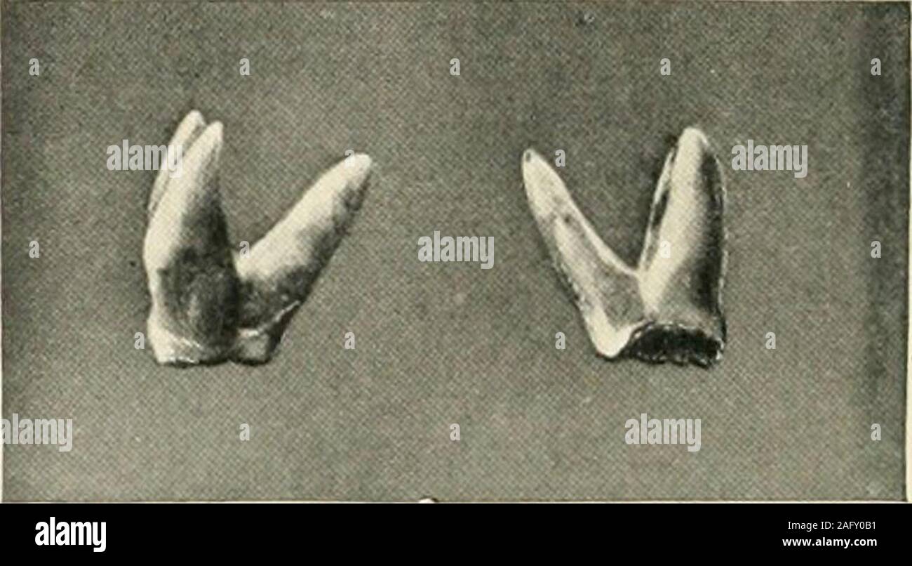 Abnormalities of teeth hi-res stock photography and images - Alamy