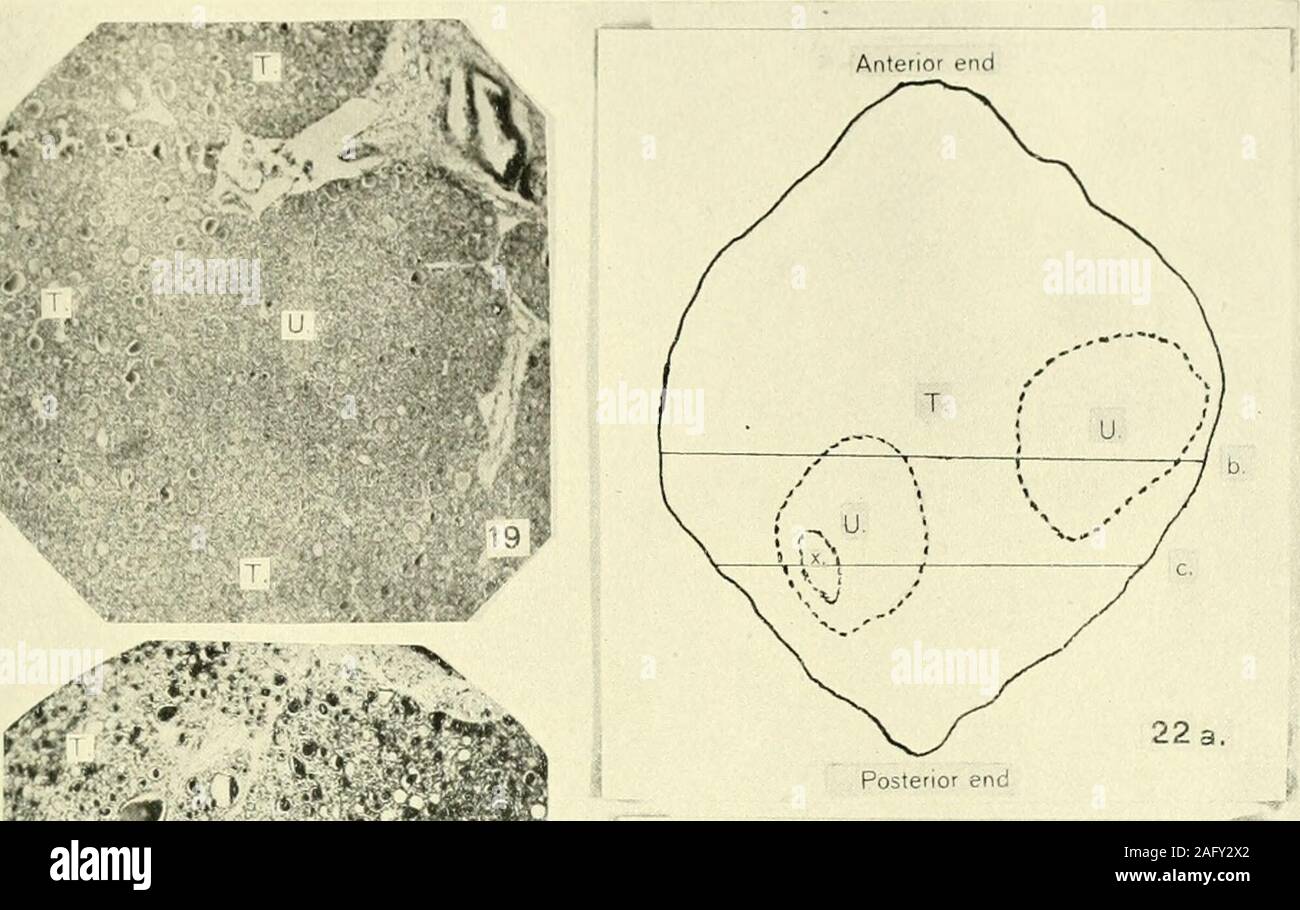 Colloid in thyroid hi-res stock photography and images - Alamy