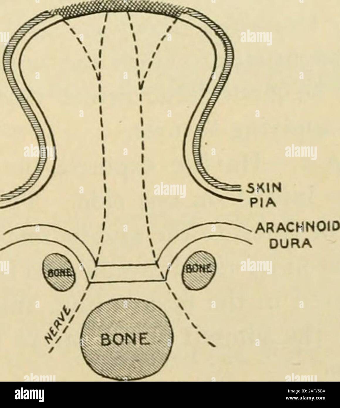 . Manual of operative surgery. Fig. 931.—Meningocele B.. Fig. 933 ...