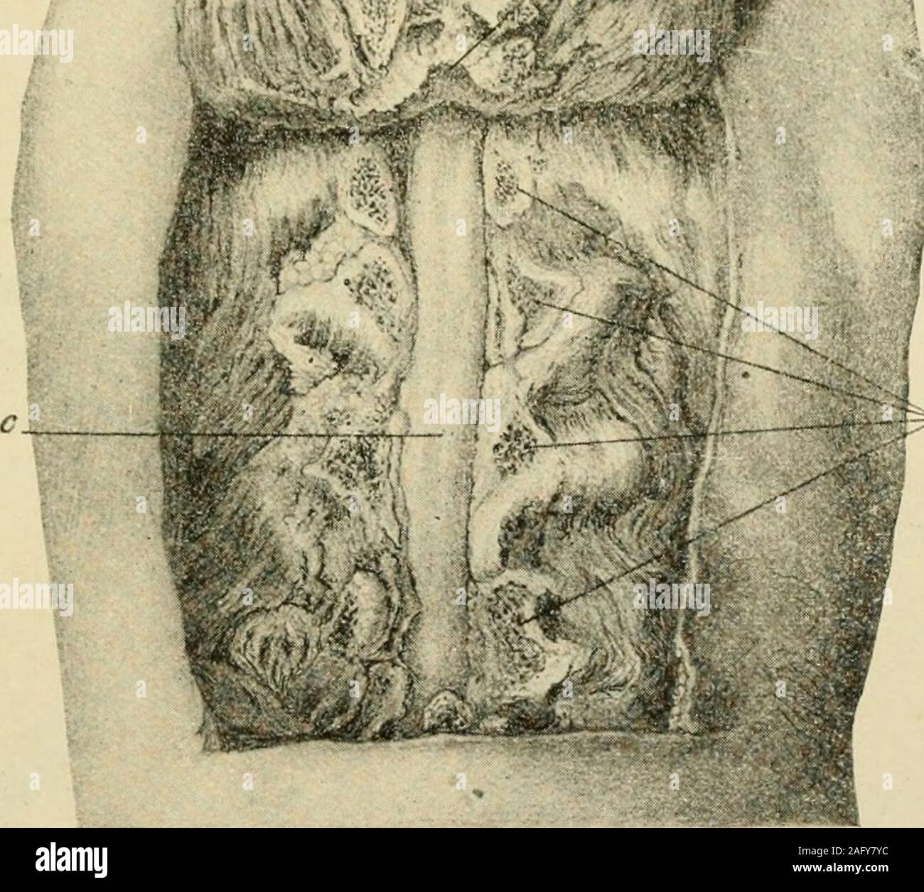 . Manual of operative surgery. Fig. 924.—Osteoplastic laminectomy ...