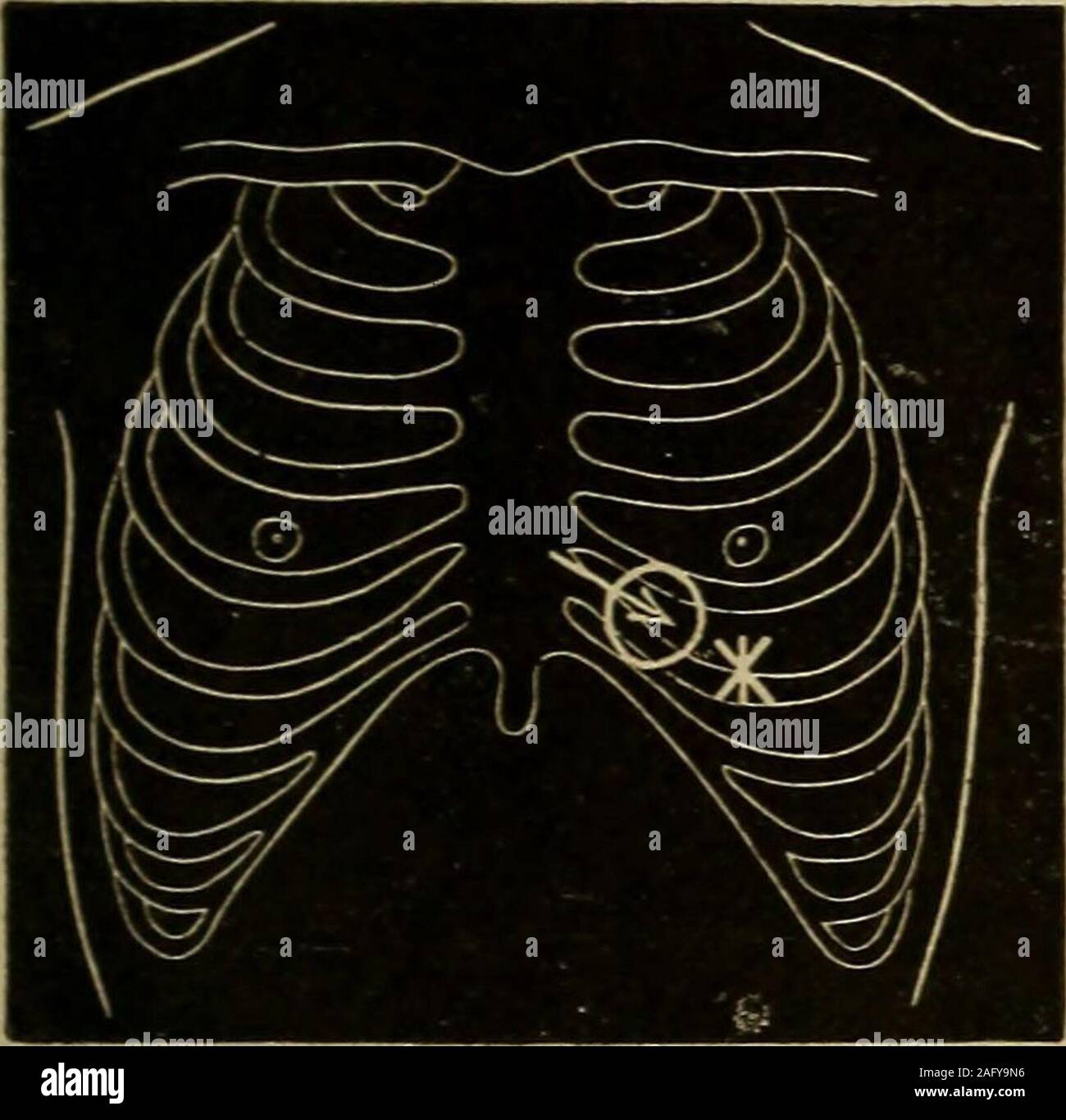 . Medical diagnosis for the student and practitioner. the left auricle ...