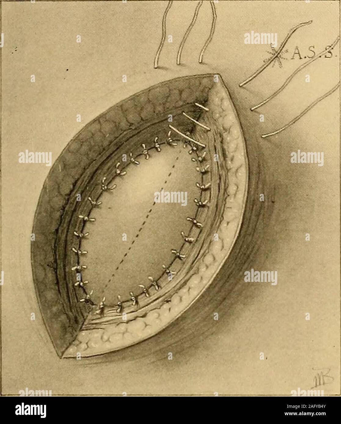 . Operative gynecology. Makoto a Sigmoid Ands iif Occlusion of the ...