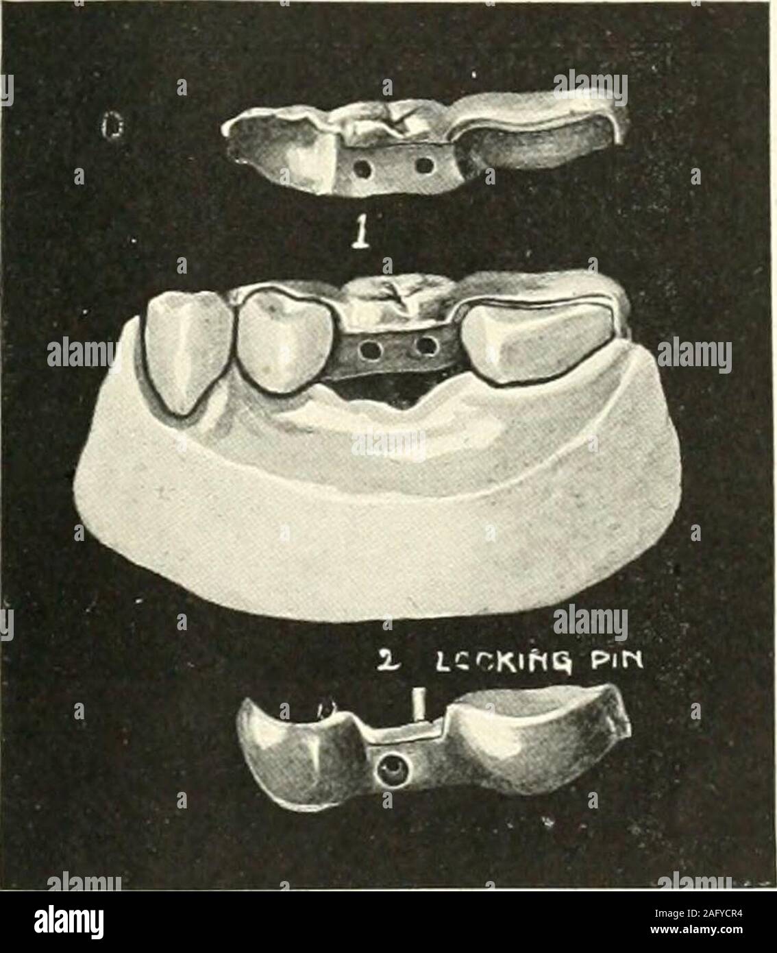 Molar groove hi-res stock photography and images - Alamy
