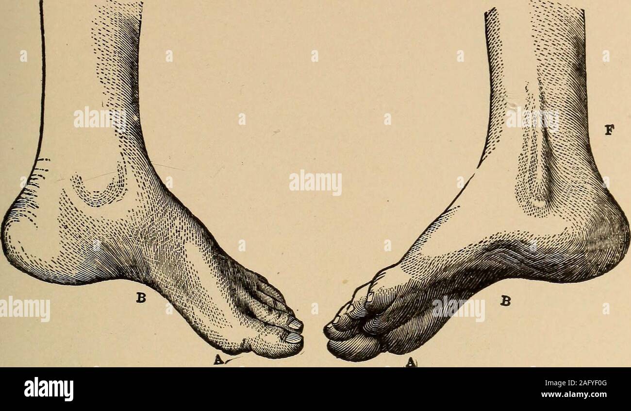 Peroneal muscular atrophy hi-res stock photography and images - Alamy