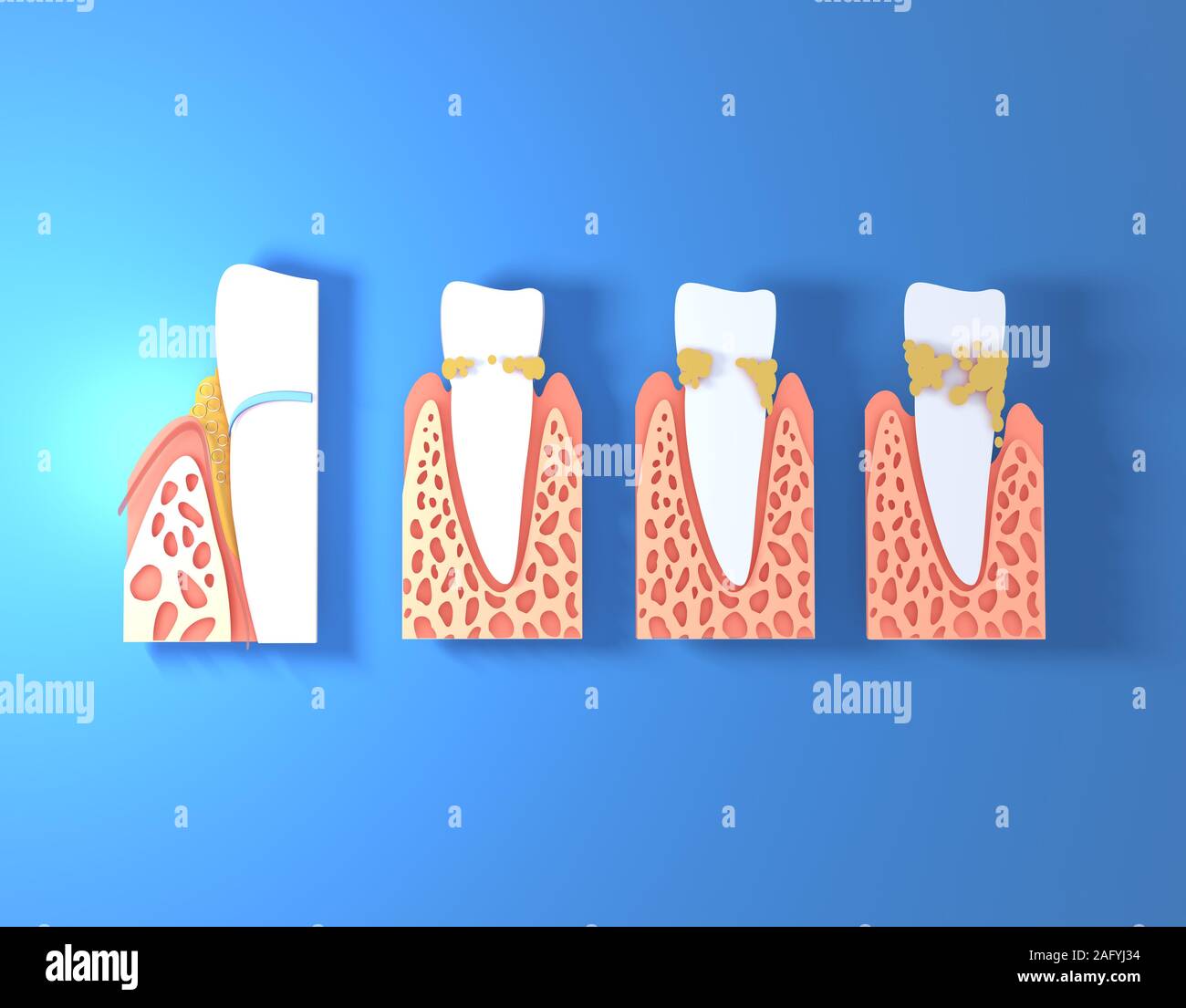 3d illustration of paper teeth with tartar. Showing four different ...