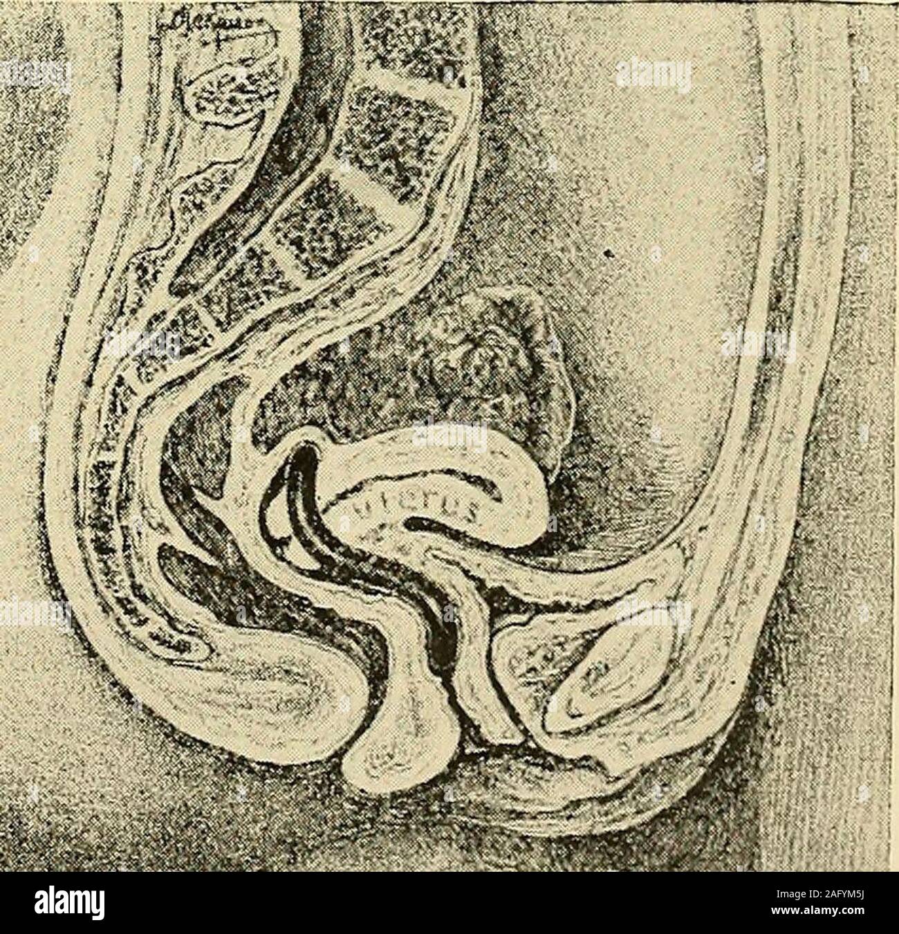 Pessary pelvic hi-res stock photography and images - Alamy