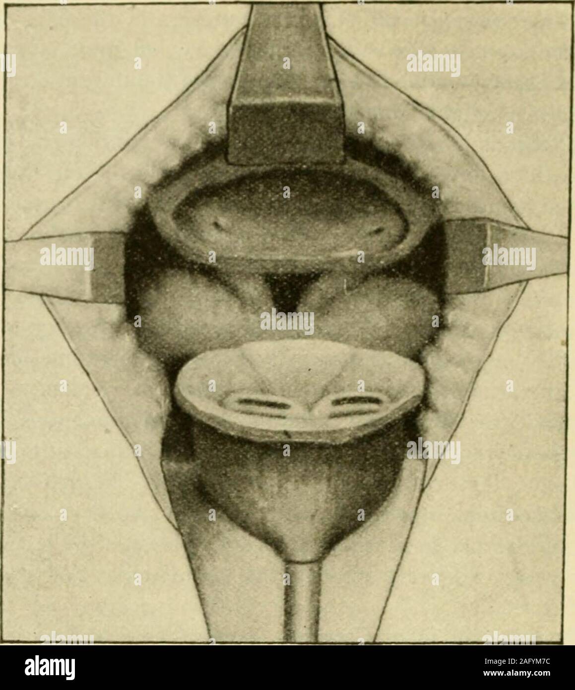 Blunt dissection hi-res stock photography and images - Alamy