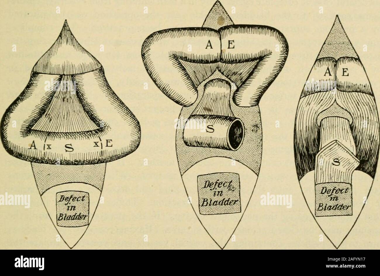 Drainage of tumor hi-res stock photography and images - Alamy