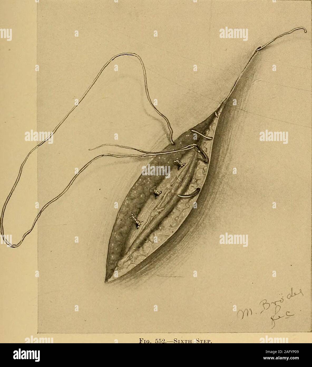 Pouparts ligament hi-res stock photography and images - Alamy