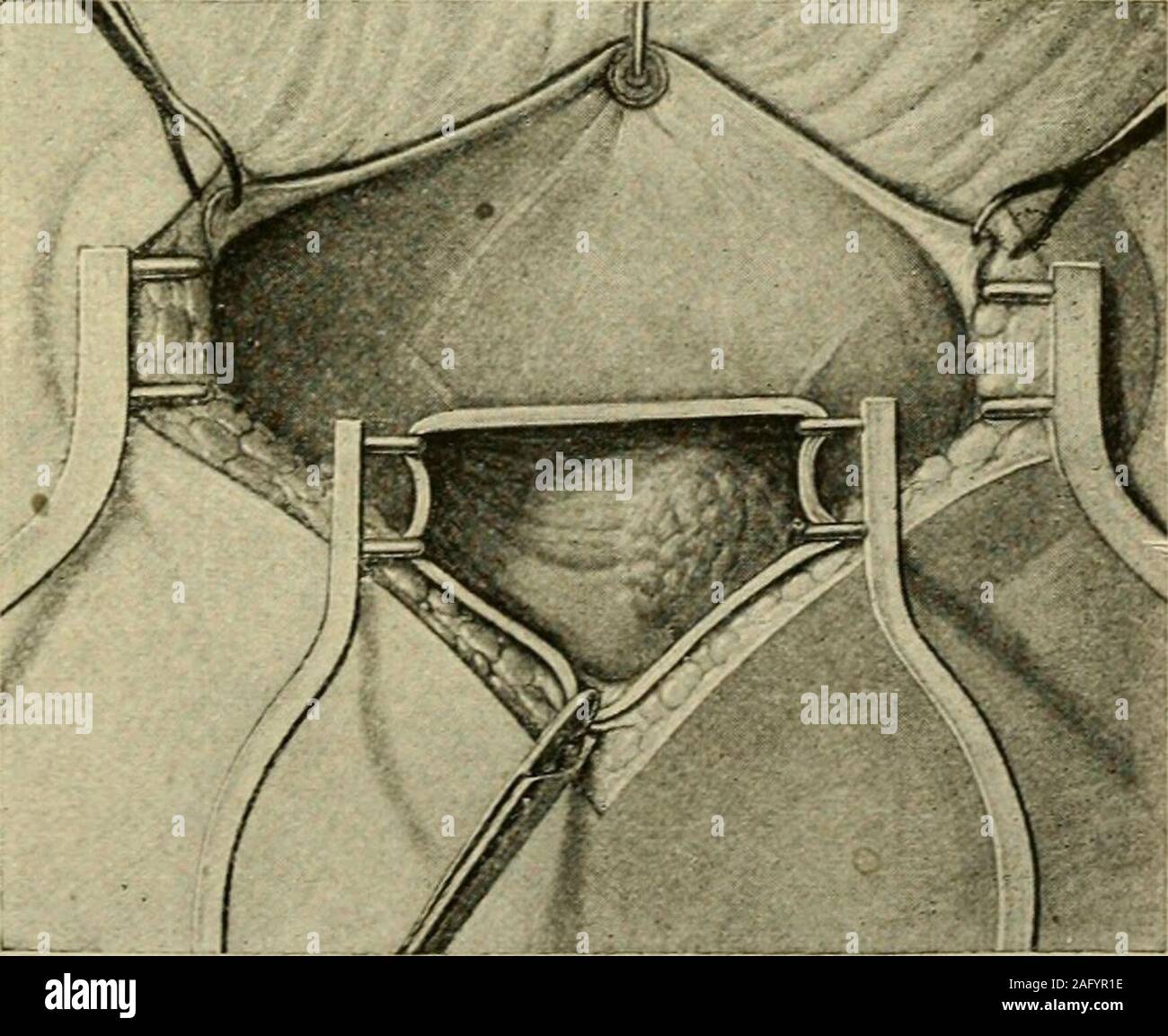 Pelvic floor surgery hi-res stock photography and images - Alamy