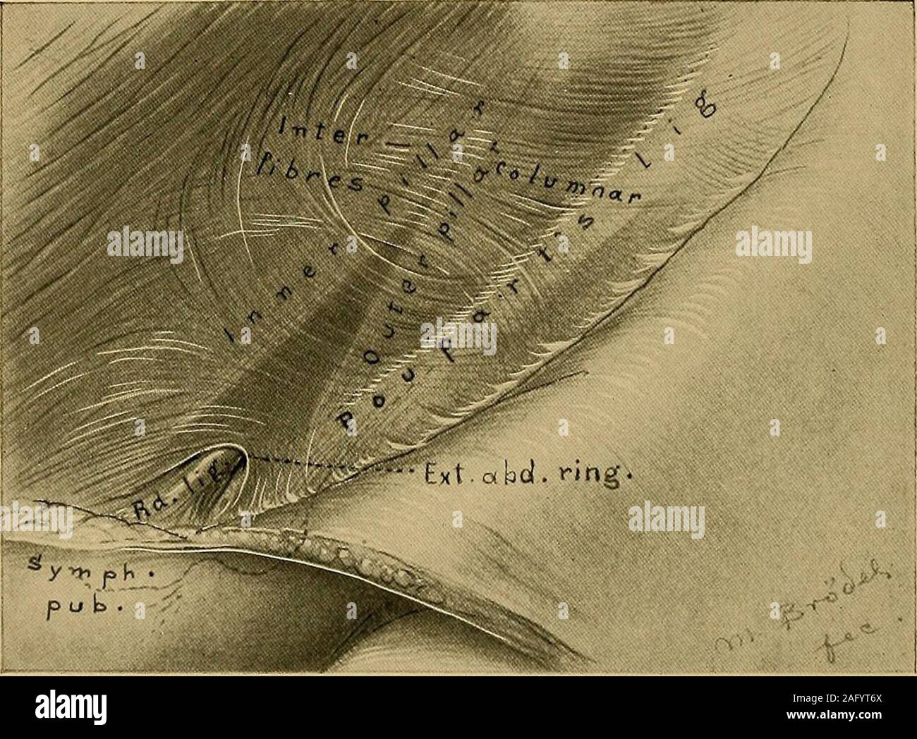 Subcuticular suture hi-res stock photography and images - Alamy