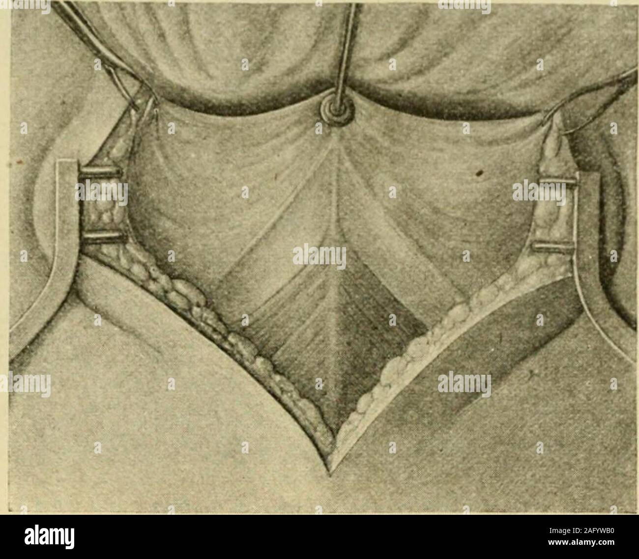 . Manual of operative surgery. Fig. 847.—Partial cystectomy. Suture of ...