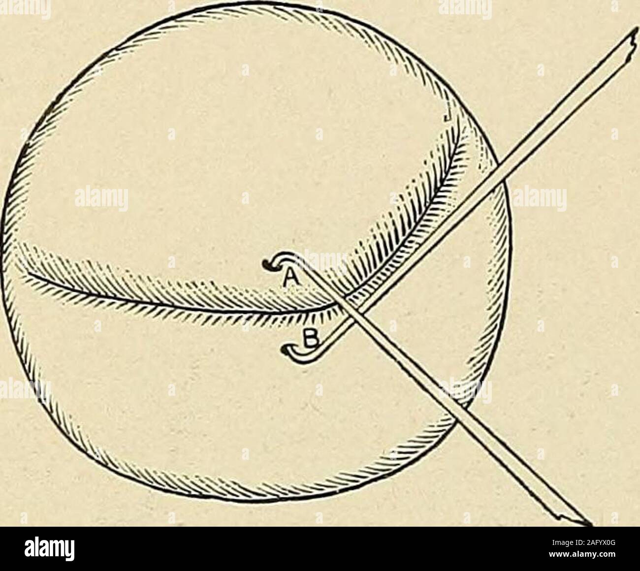 Tenaculum hi-res stock photography and images - Alamy