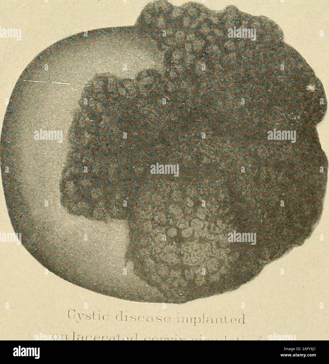 Cervix erosion hi-res stock photography and images - Alamy