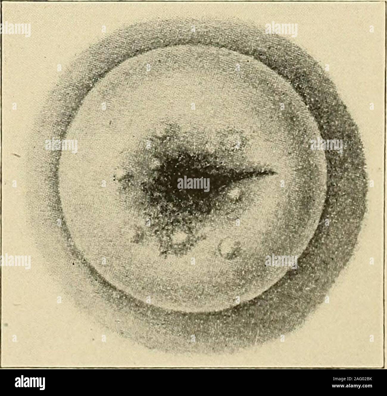 Cervix erosion hi-res stock photography and images - Alamy