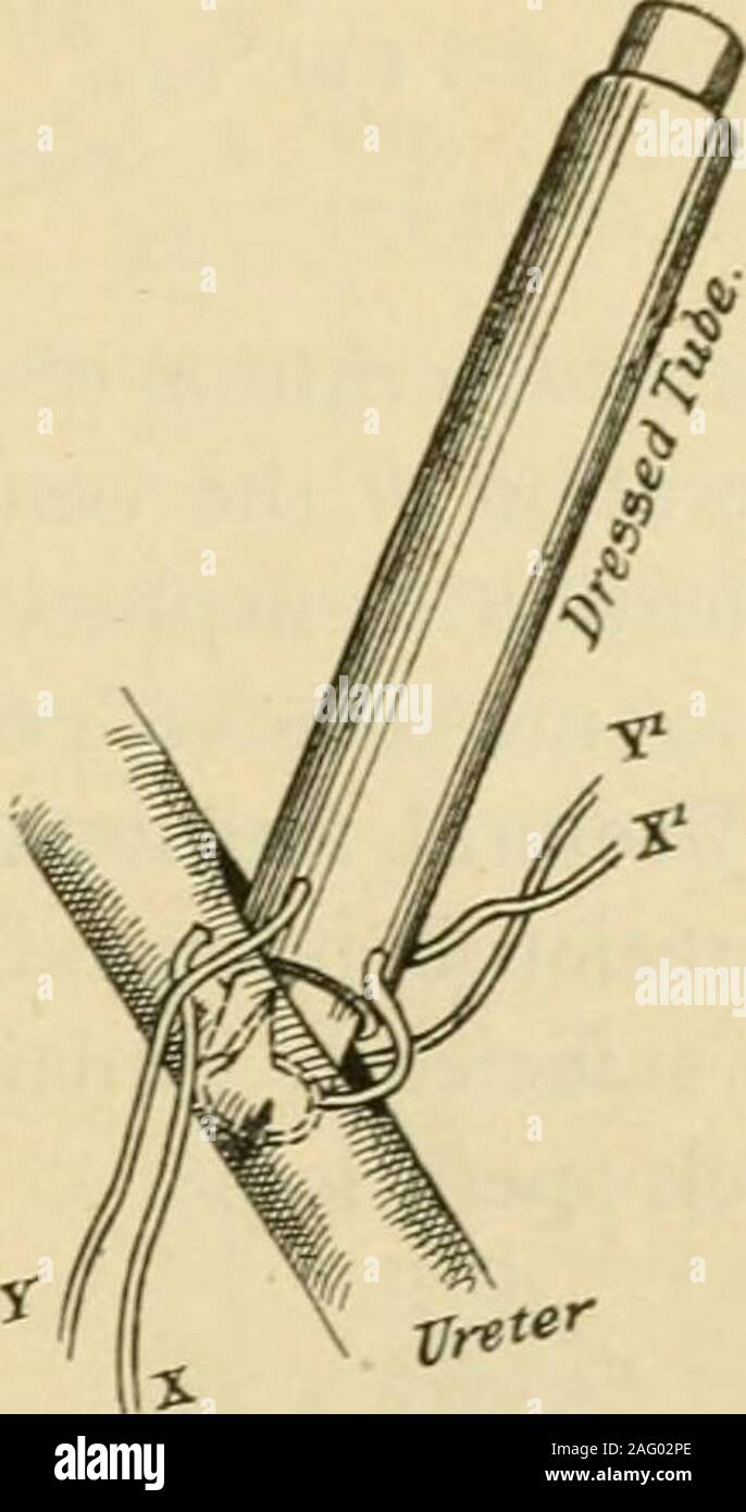 . Manual of operative surgery. Fig. 819. Fig. 820. Fig. 821.—Ureteral ...