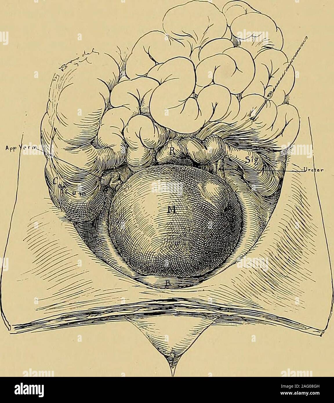 Myomectomy hi-res stock photography and images - Alamy