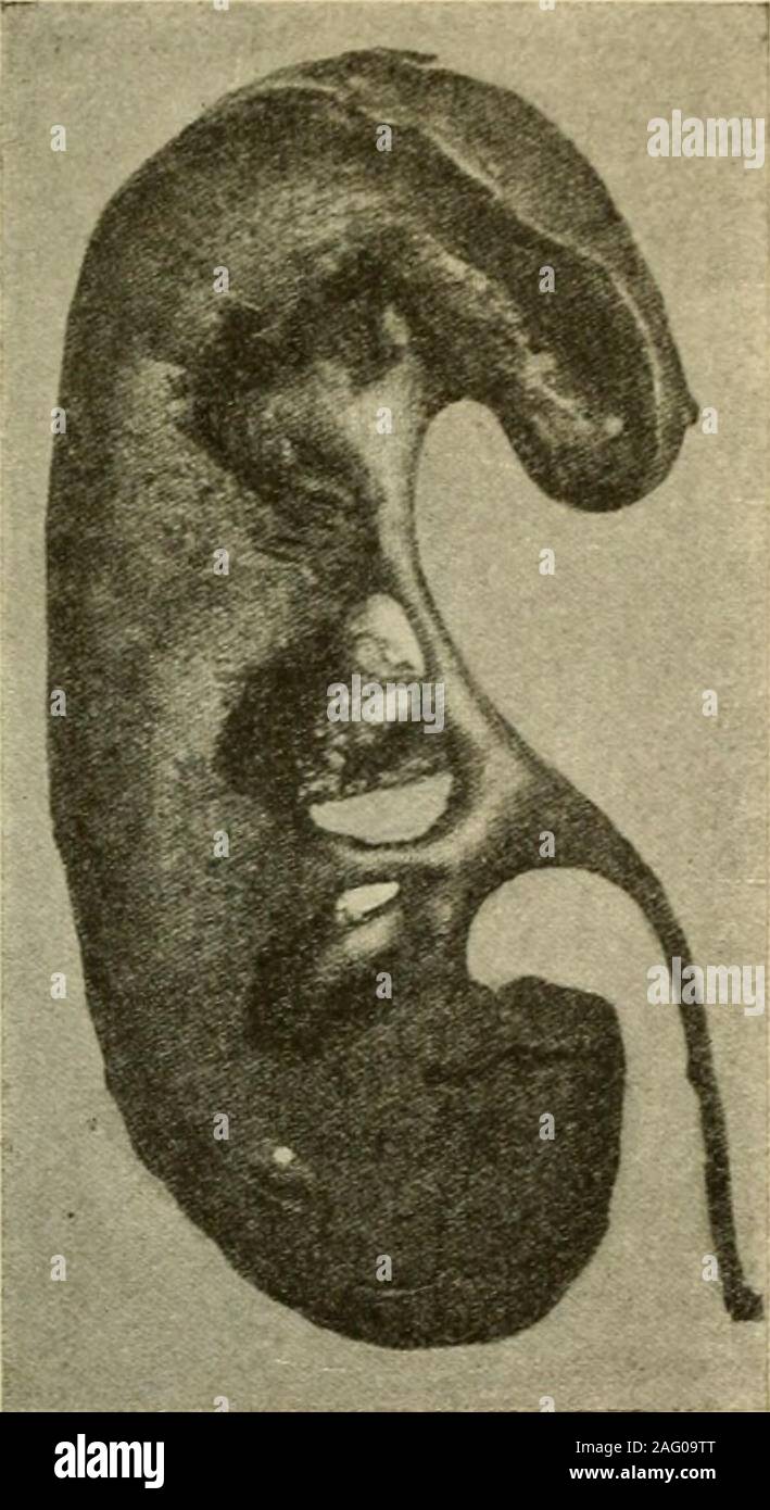 . Manual of operative surgery. FiG. 785.—Trifid pelvis. {Delbet and ...