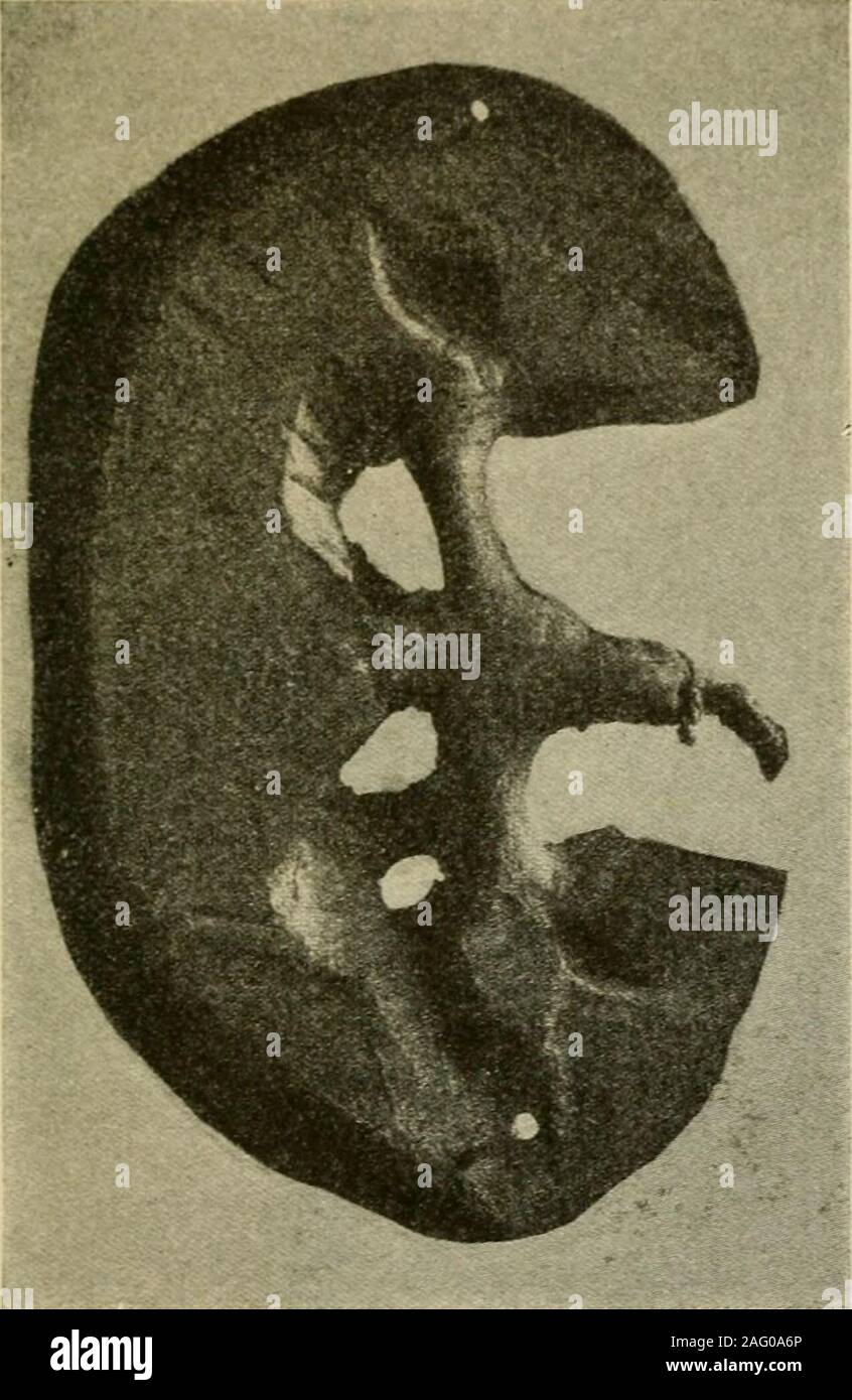 . Manual of operative surgery. except the calices and these are plugged ...