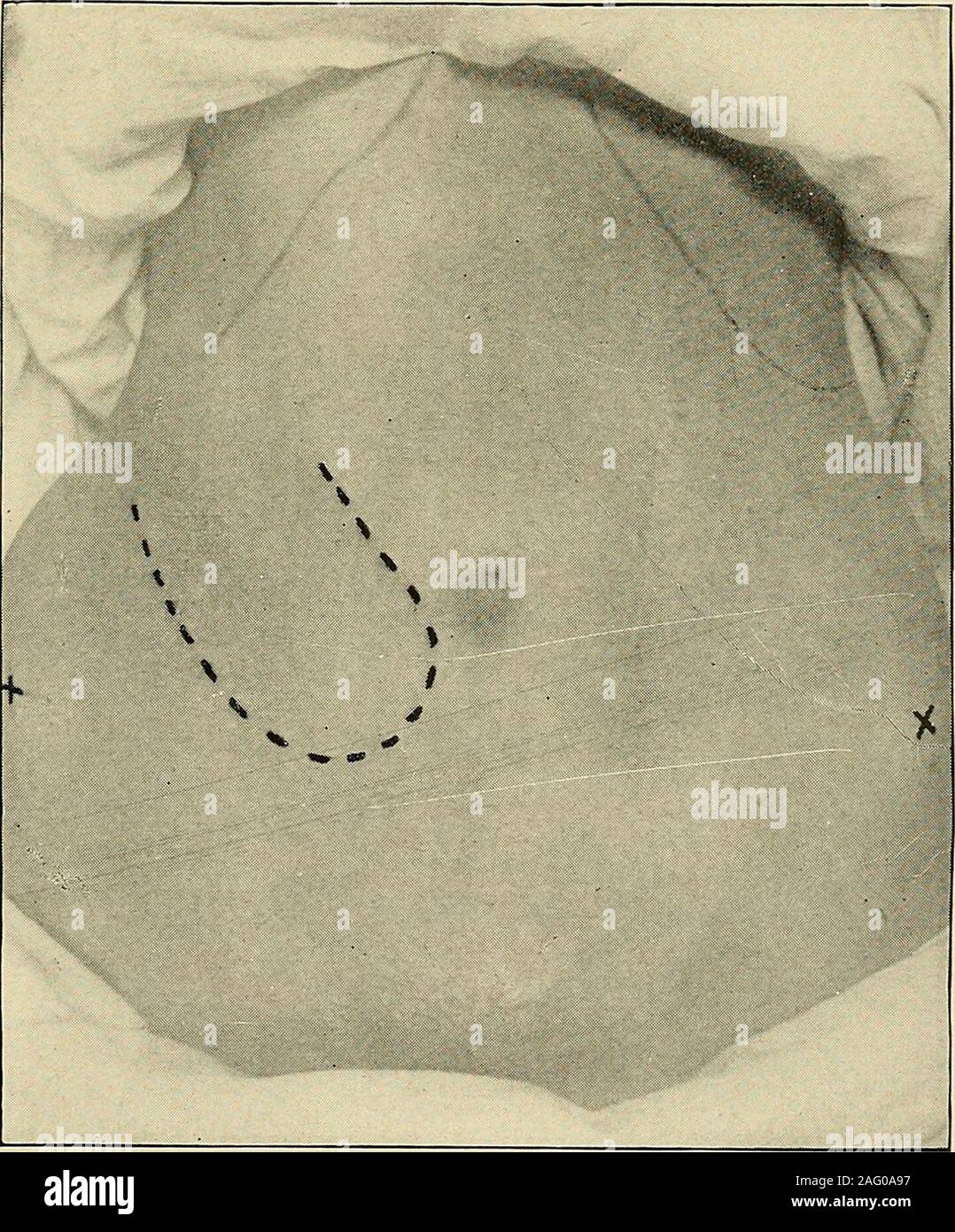 . The diagnosis and treatment of diseases of women. Fig. 411. D agram ...