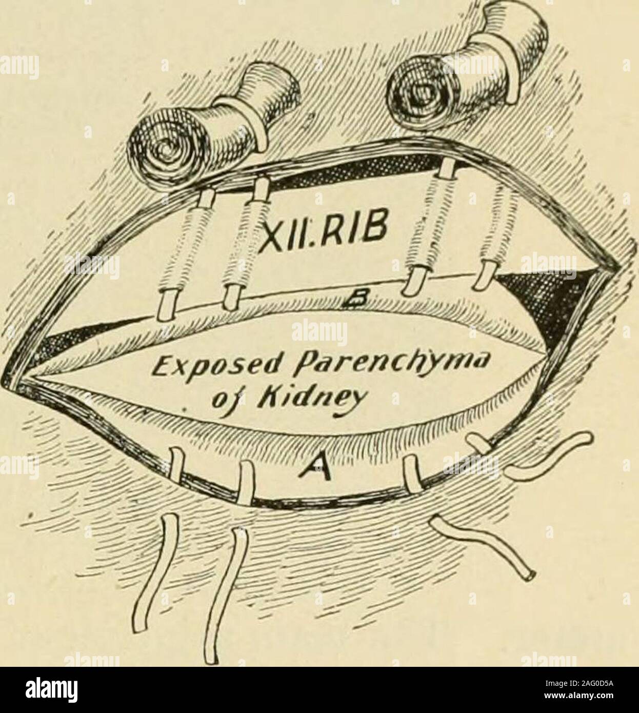 . Manual of operative surgery. Fig. 775.—Israels nephropexy. NEPHROPEXY ...