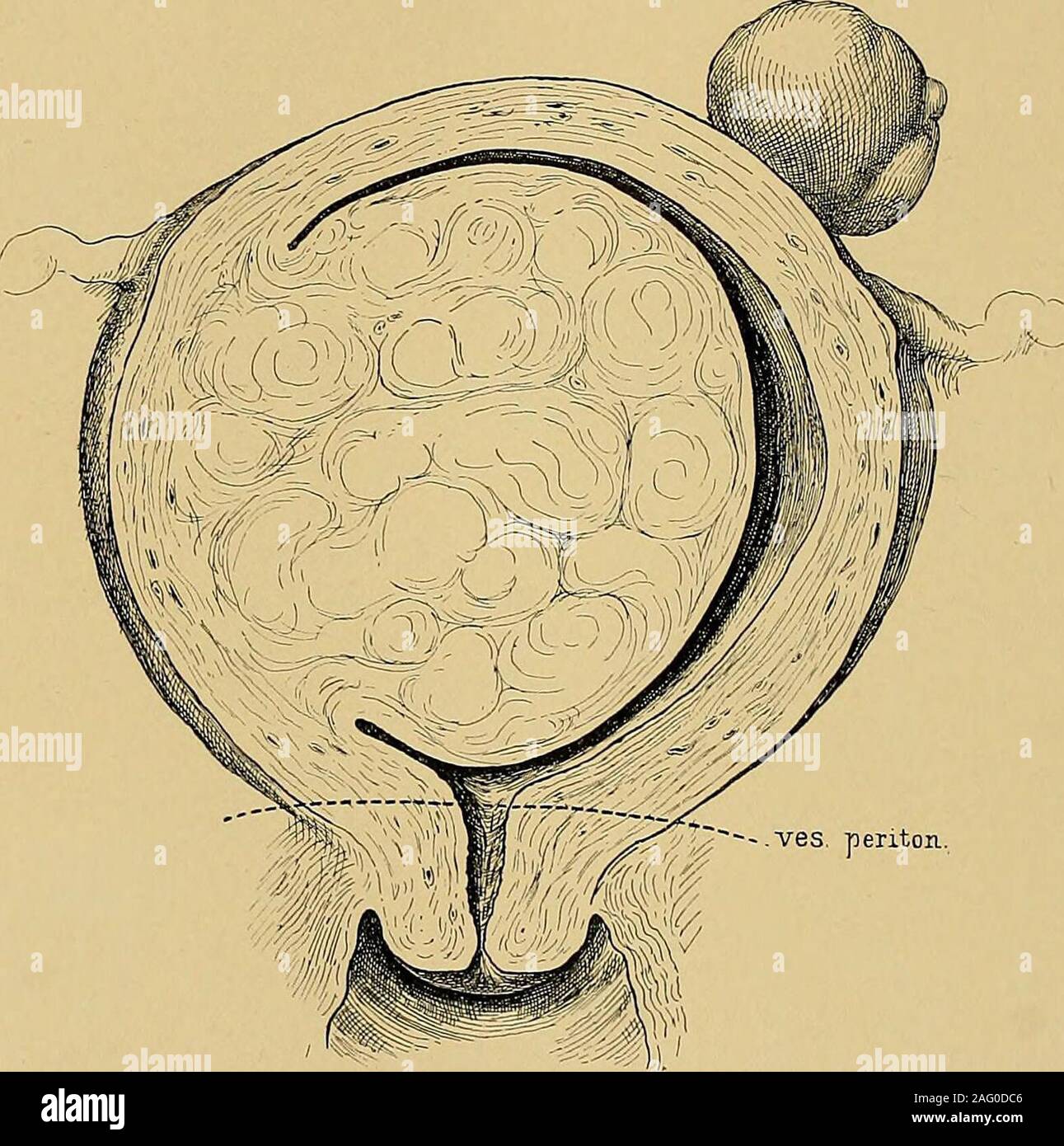 Myomectomy hi-res stock photography and images - Alamy