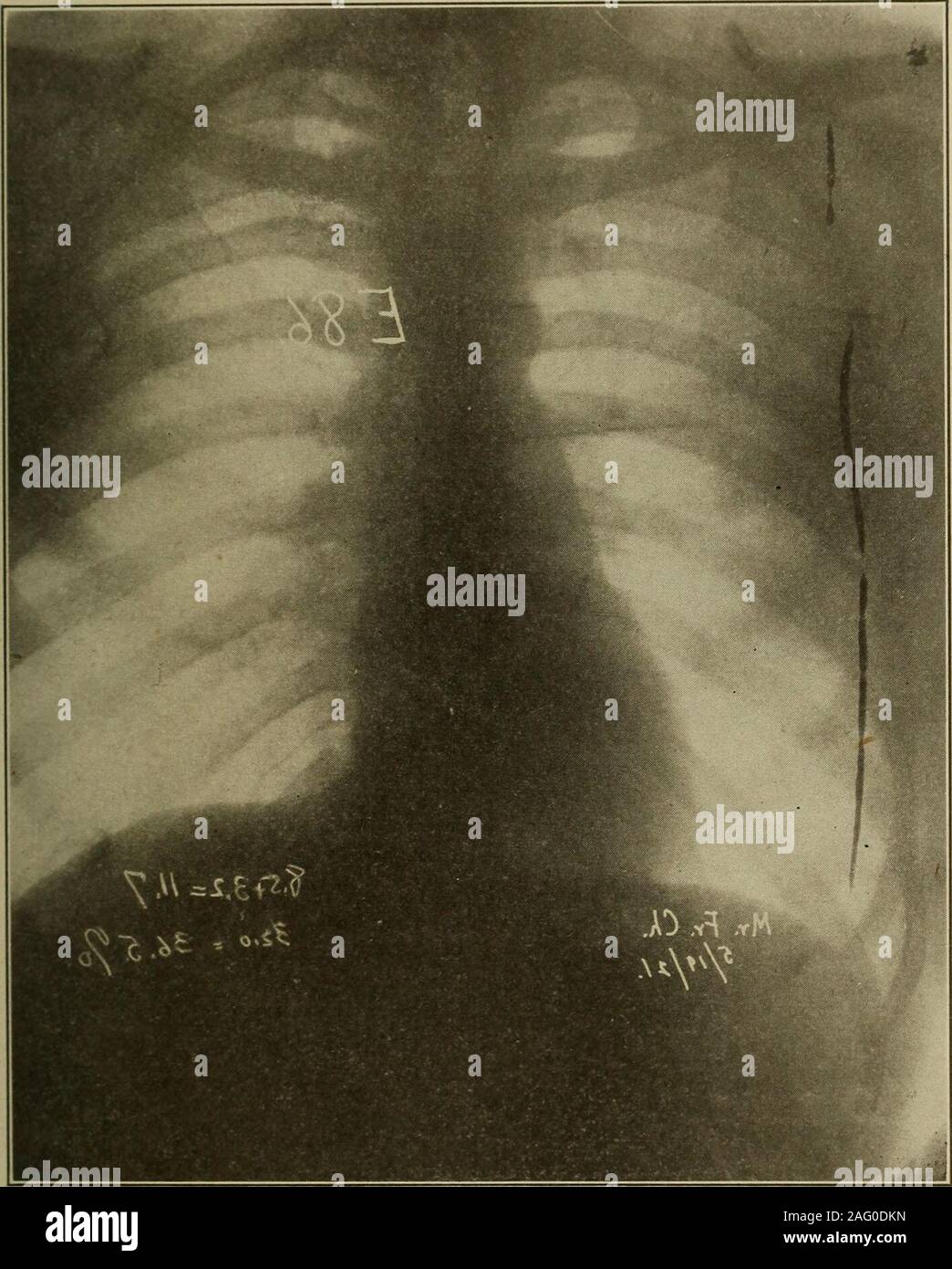 . Medical diagnosis for the student and practitioner. Fig. 318.—Same ...