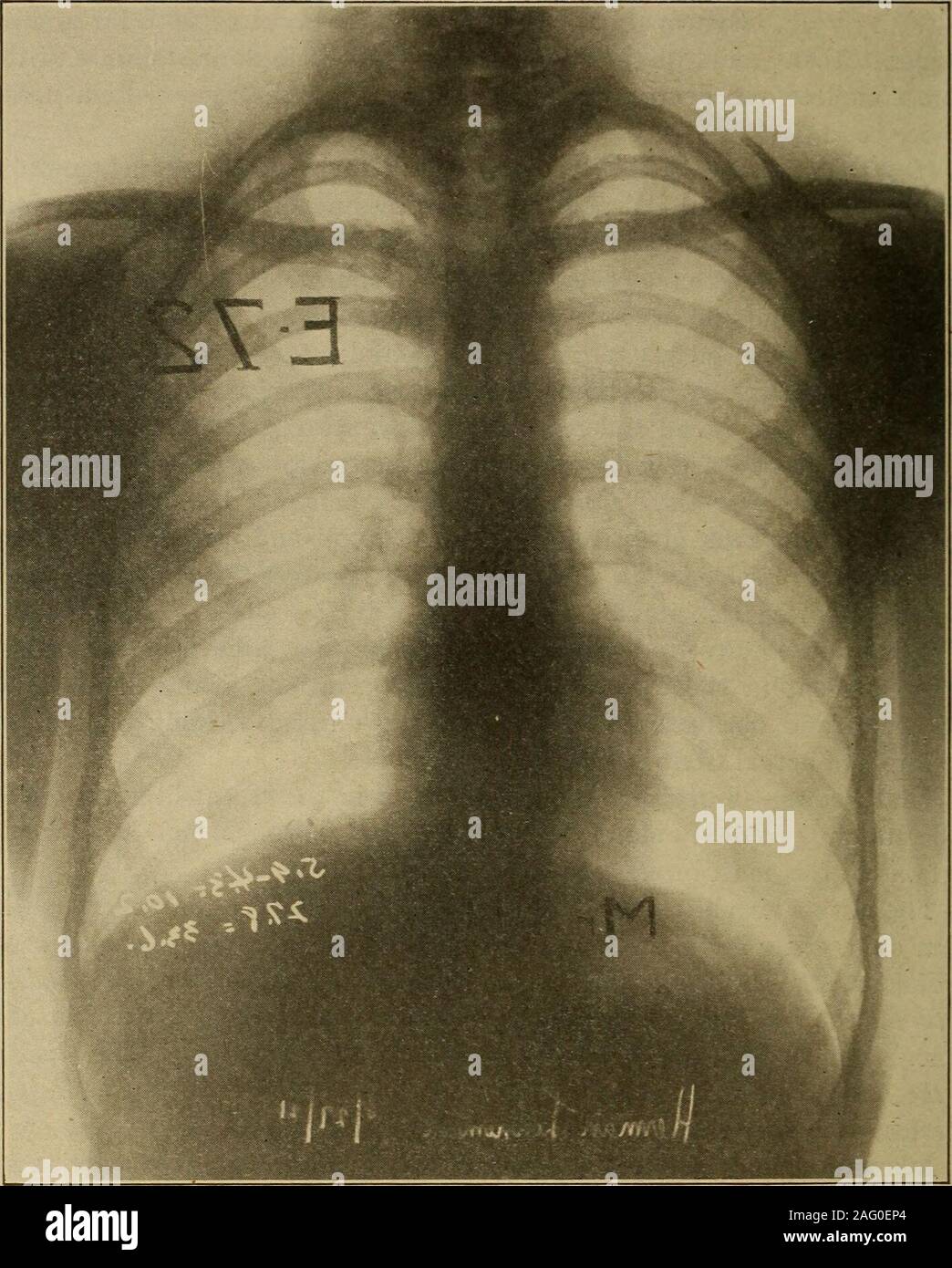 Myocardial protection hi-res stock photography and images - Alamy
