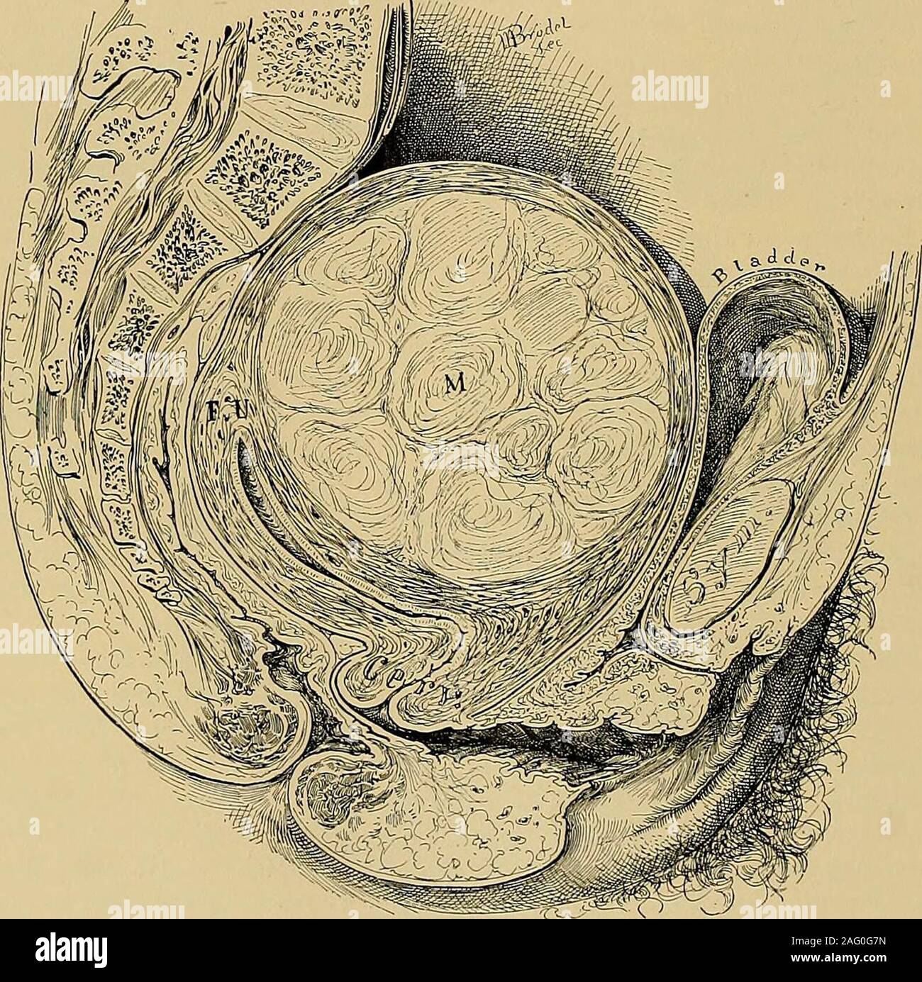 Myomectomy hi-res stock photography and images - Alamy