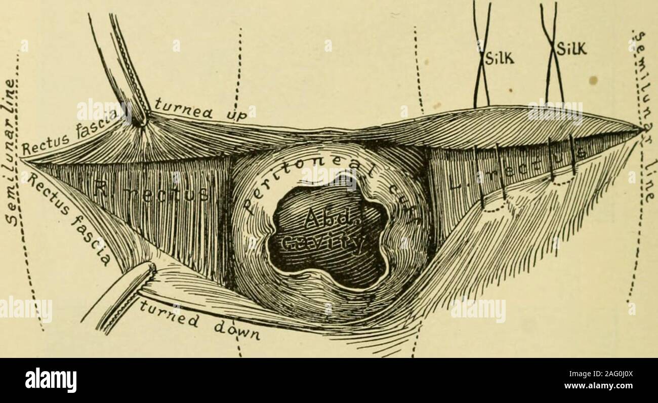 Hernia mesh surgery hi-res stock photography and images - Alamy