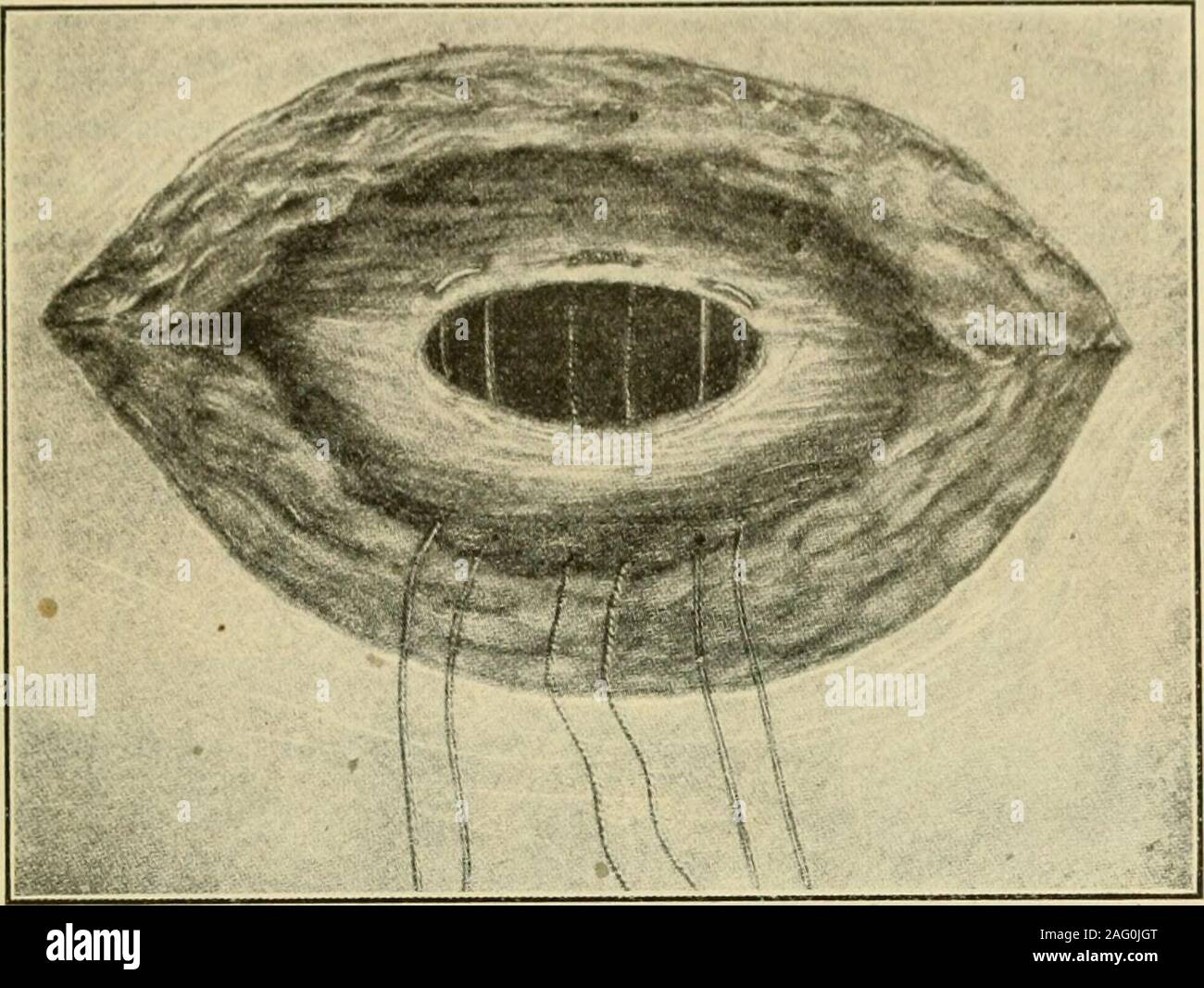 . Manual of operative surgery. rnia. {Mayo.) Step I.—Make a curved ...