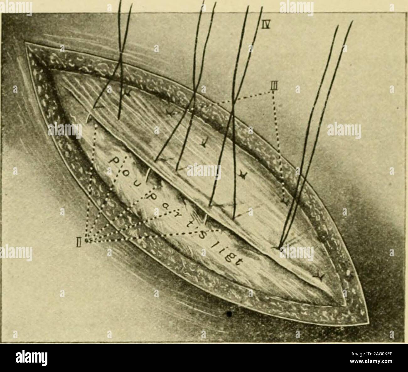 . Manual of operative surgery. Fig. 757.—{Halsted.) Step 7.—Stitch the ...