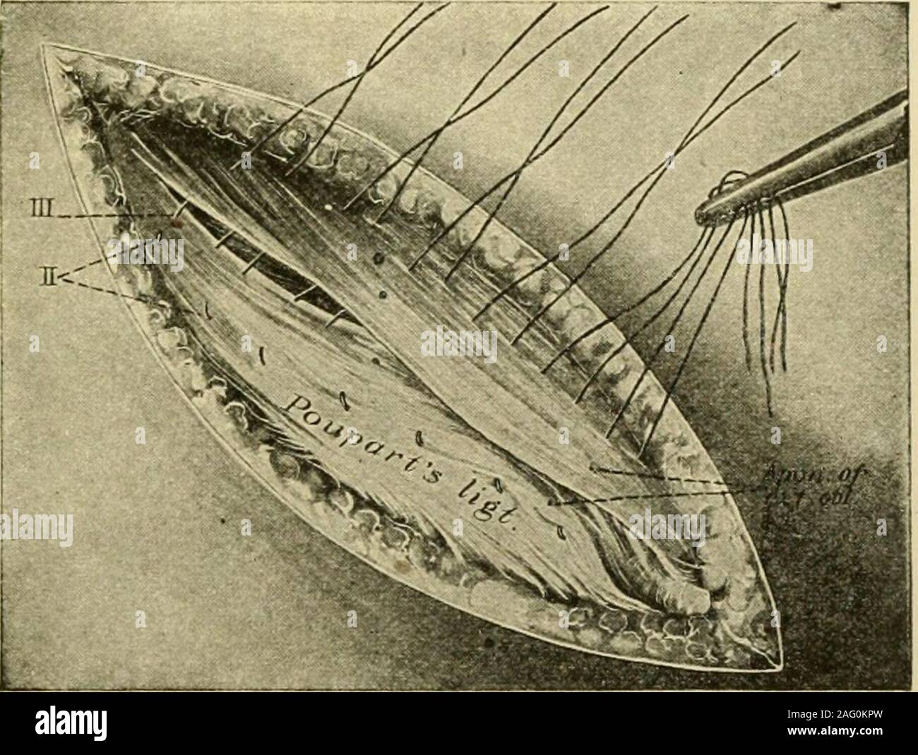 . Manual of operative surgery. Fig. 756.—(Halstcd.). Fig. 757.—{Halsted ...