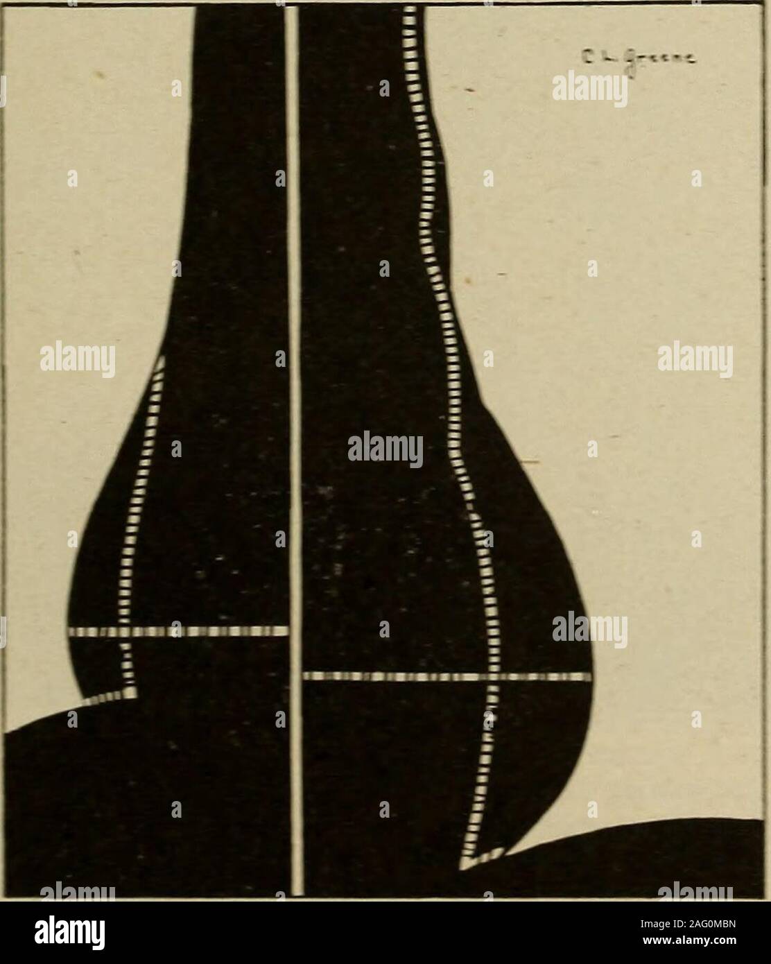 . Medical diagnosis for the student and practitioner. Fig. zo2.—Dilated ...