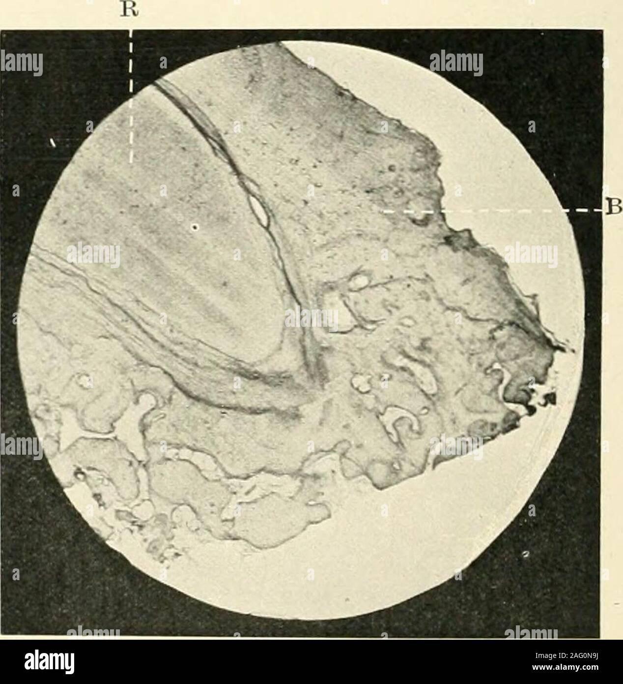 Granulation tissue hi-res stock photography and images - Alamy