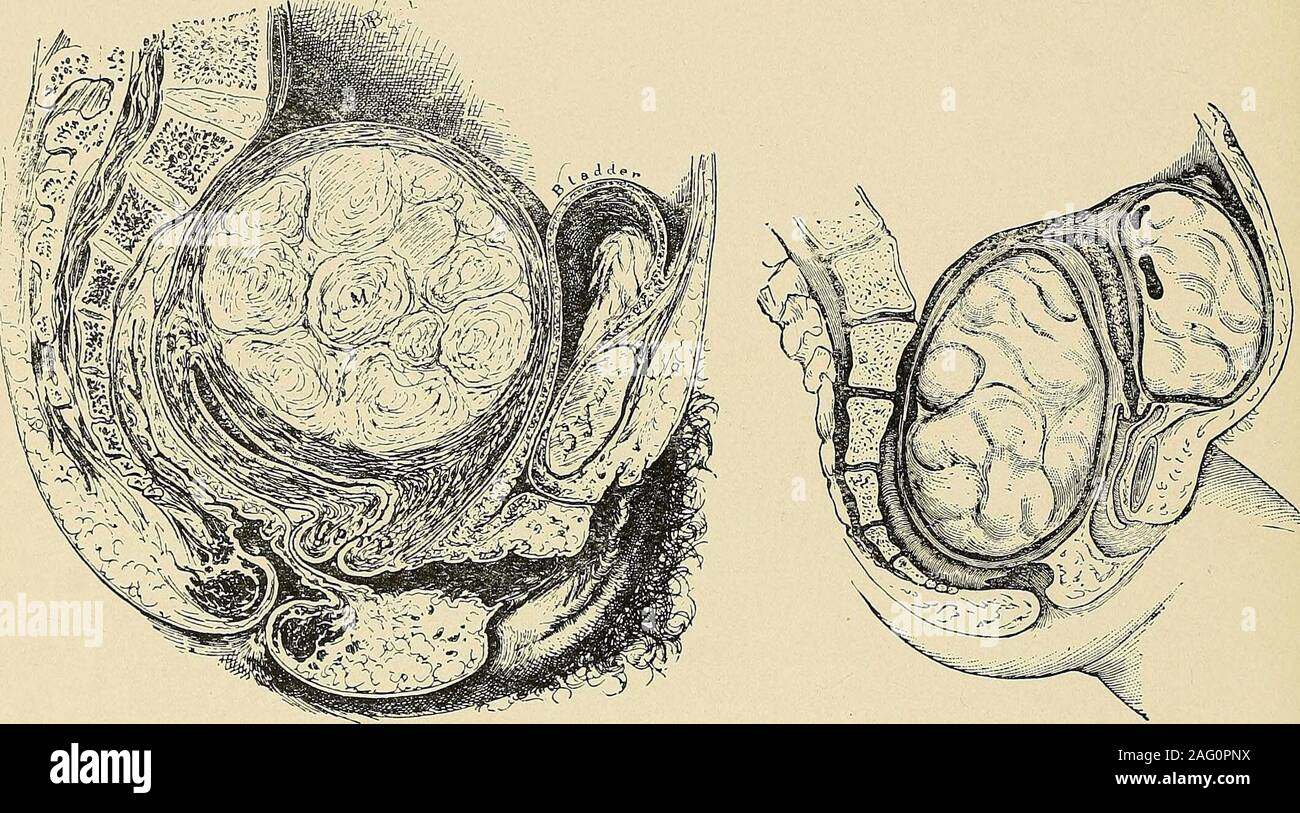 . The diagnosis and treatment of diseases of women. Fig. 375 ...