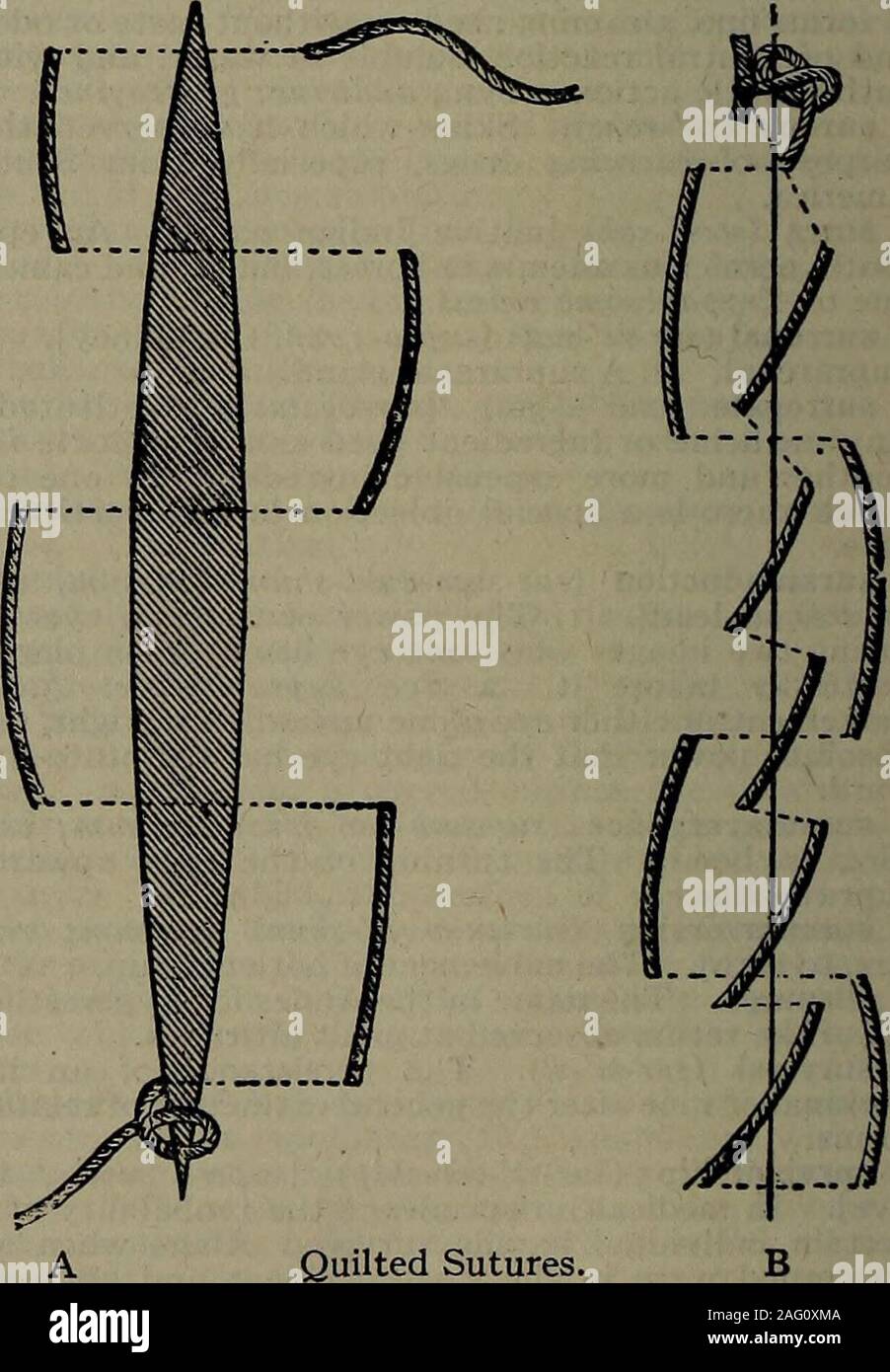 Retention Suture High Resolution Stock Photography and Images - Alamy