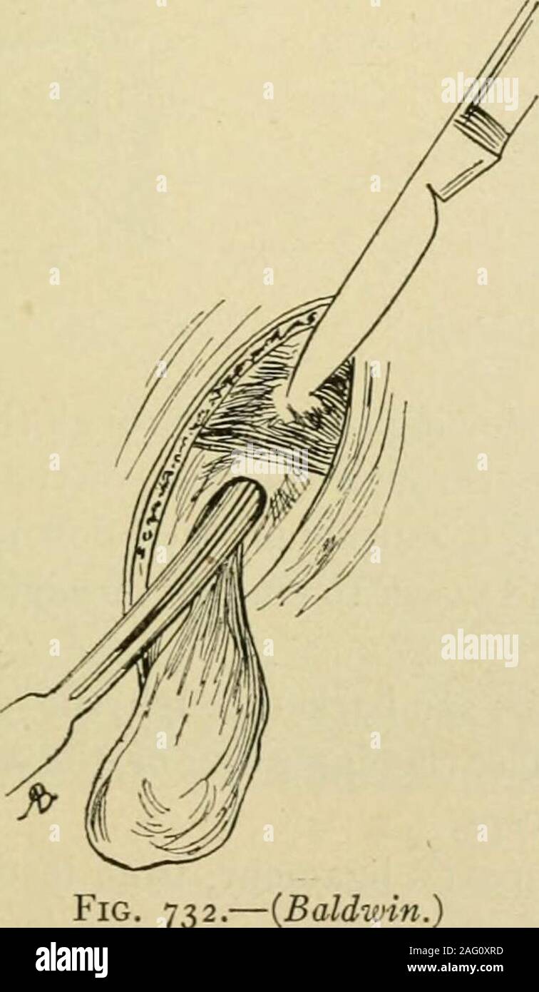 . Manual of operative surgery. Fig. 730.—Bassinis operation. Fig. 731 ...