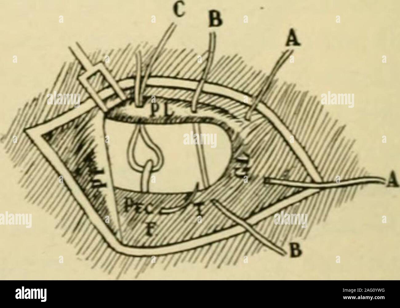 . Manual of operative surgery. Fig. 728.—Incision femoral hernia. Fig ...