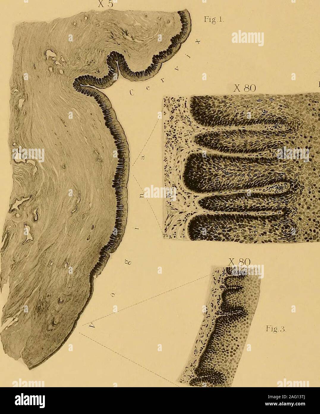 . Operative gynecology. t Broad Ligament. Bunches of Vesicles onthe ...