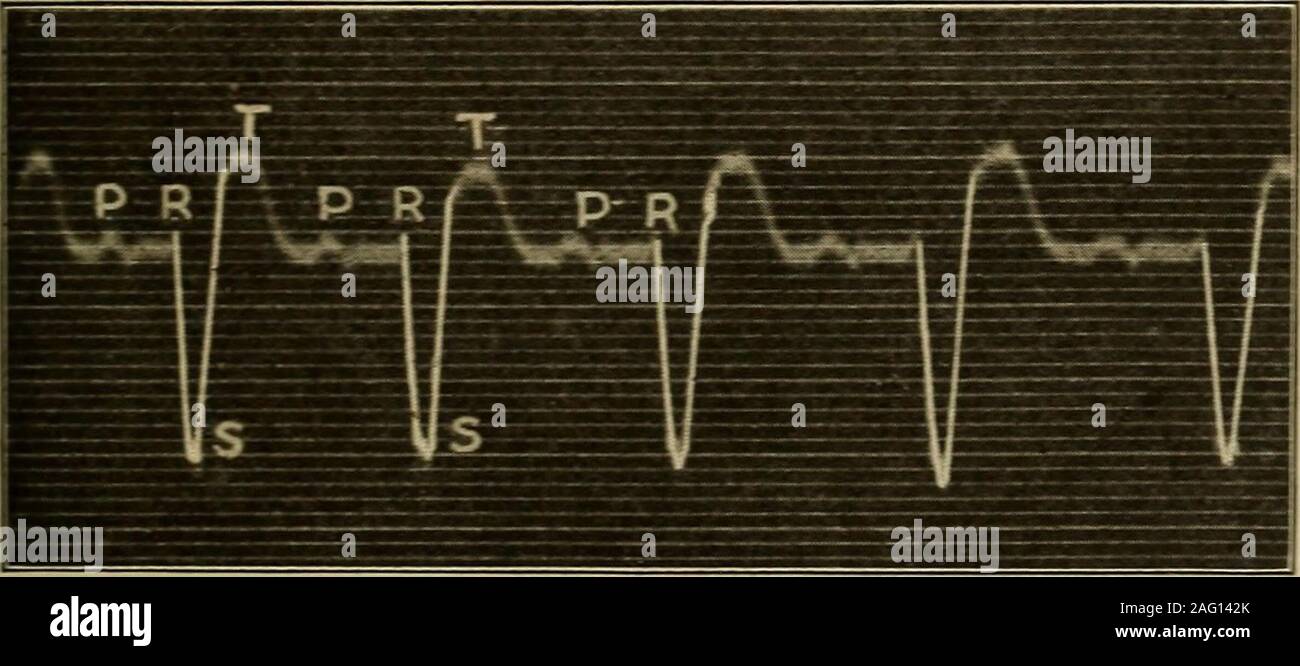. Medical diagnosis for the student and practitioner. Fig. 281.—Lead II ...