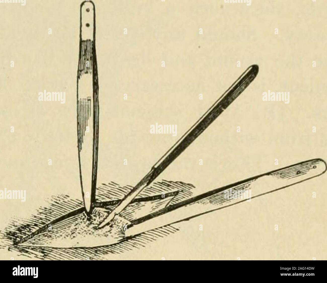 . Manual of operative surgery. Fig. 71? —Herniotomy. (Esmarchand ...