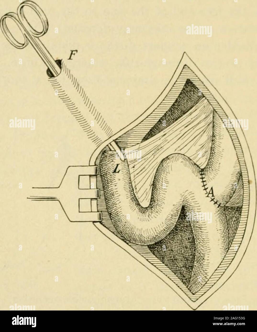 . Manual of operative surgery. ^ inches below the line of section (Fig ...