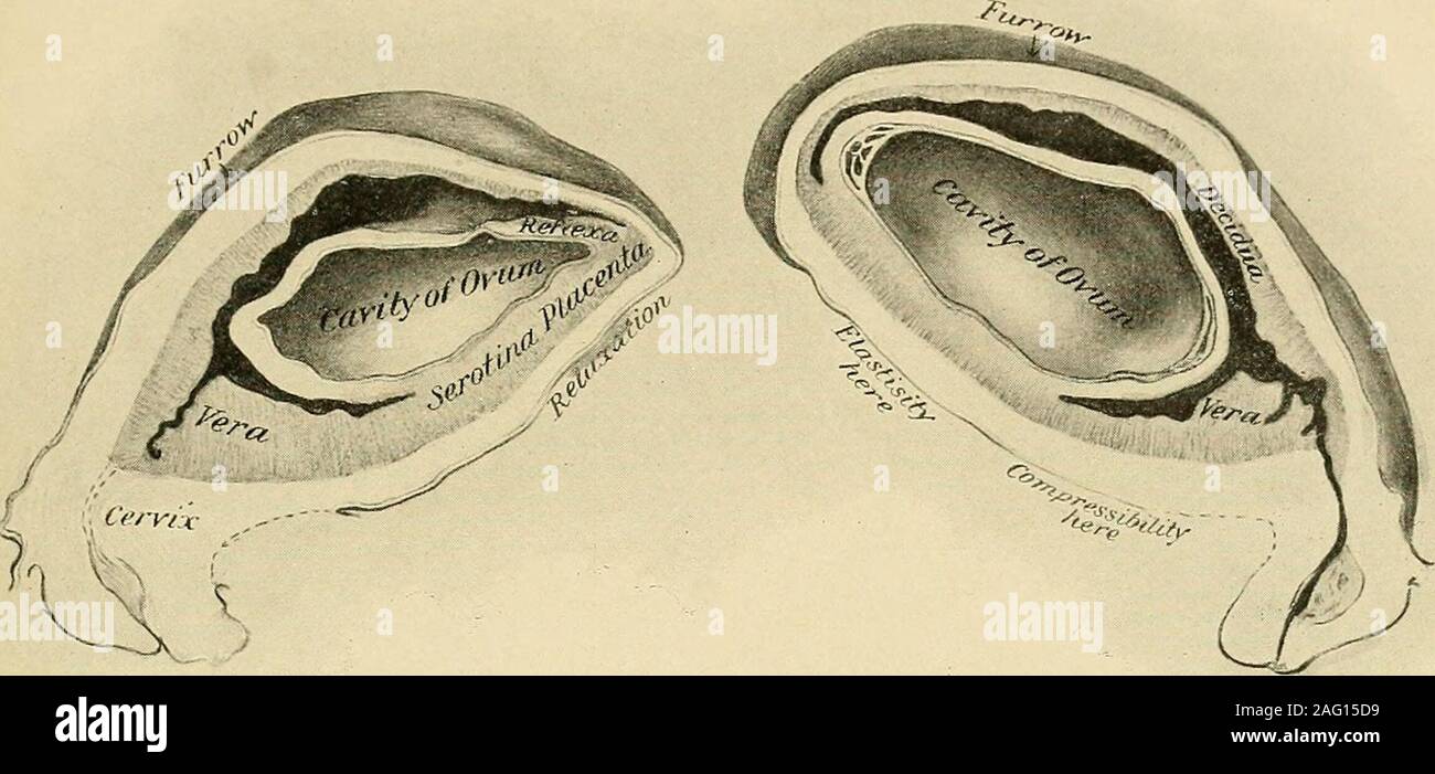 . The diagnosis and treatment of diseases of women. Fig. 350. Early ...