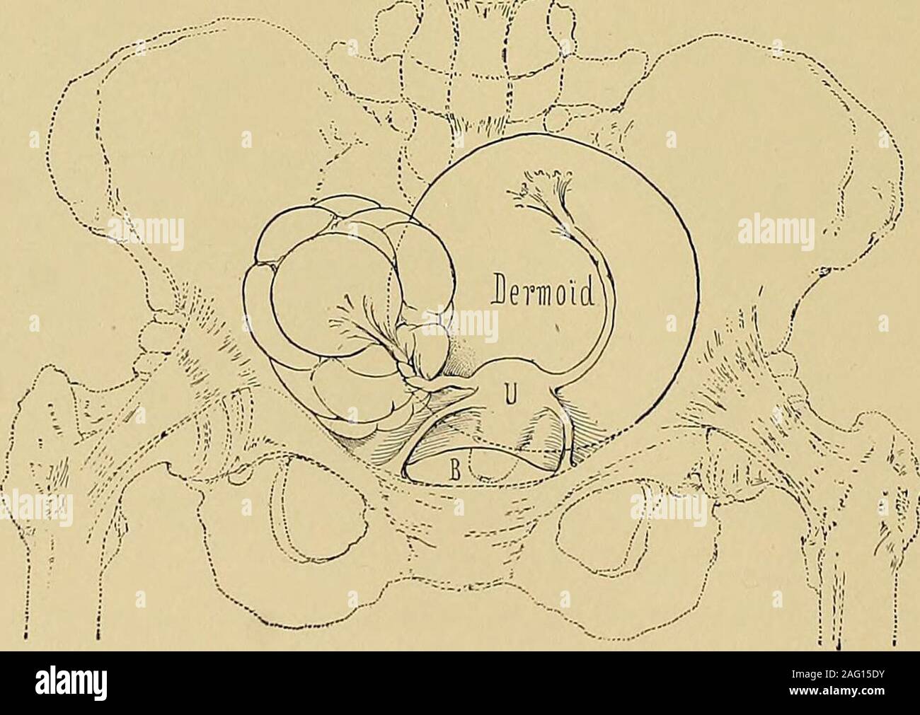 . Operative gynecology. Fto. 447-—Multiple Dermoid Cysts of Both ...