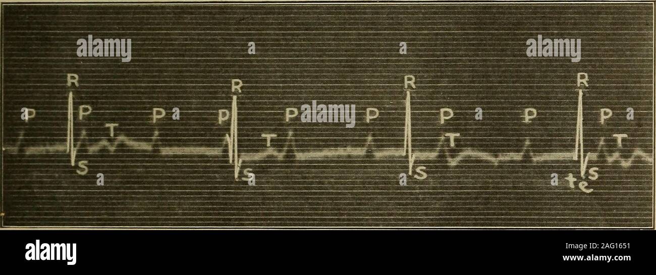 Complete heart block electrocardiogram hi-res stock photography and ...
