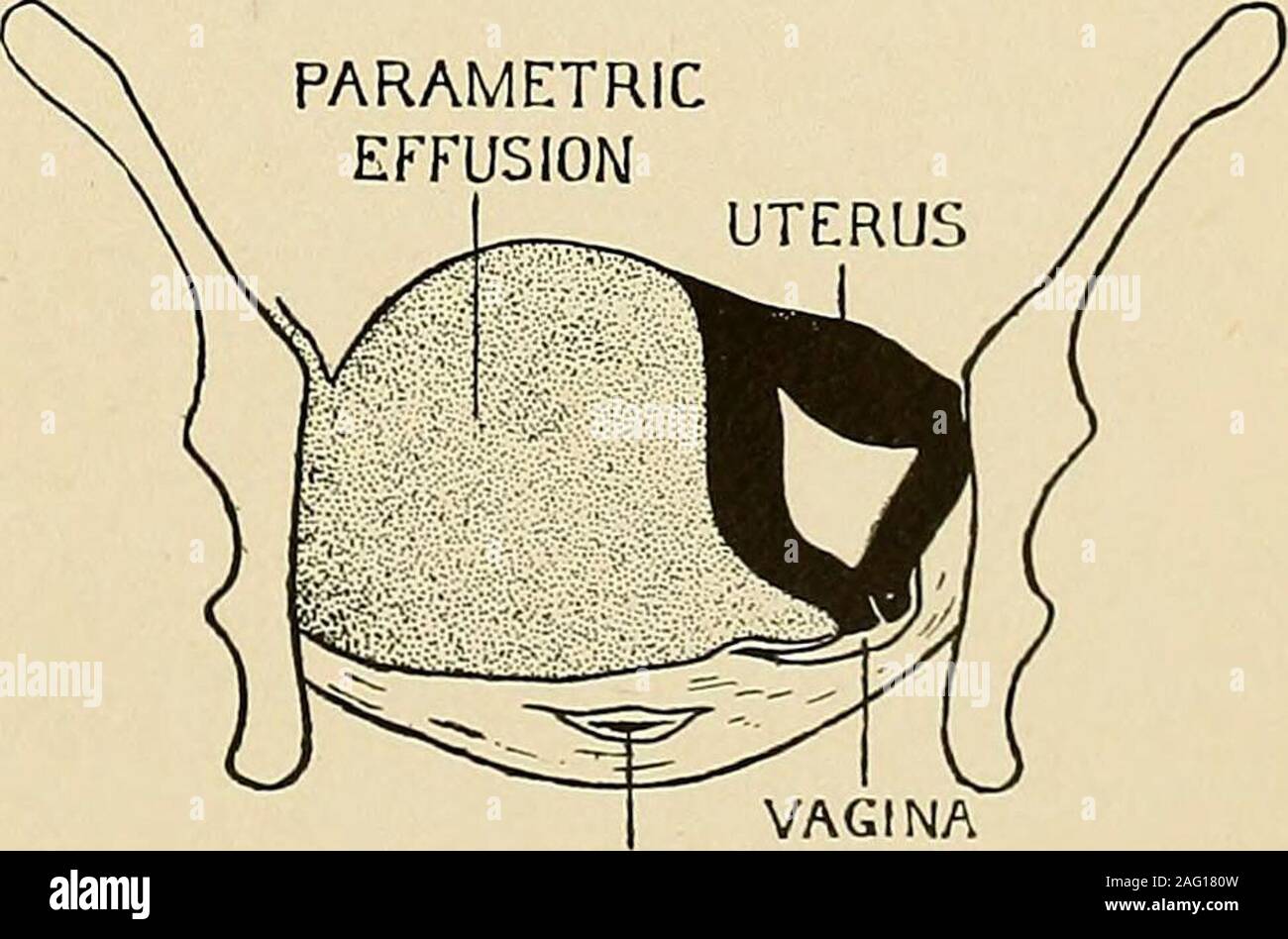 . The diagnosis and treatment of diseases of women. Fig. 344. Uterus ...