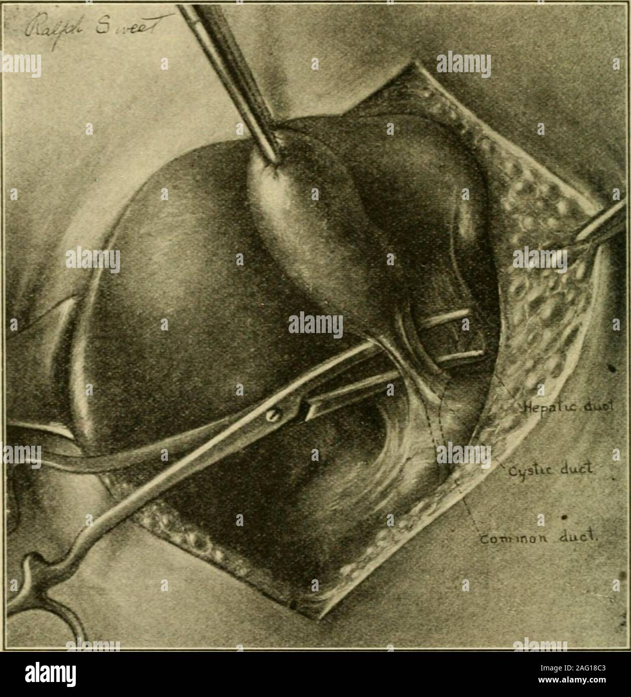 . Manual of operative surgery. ites: Theabdominal incision, instead of ...