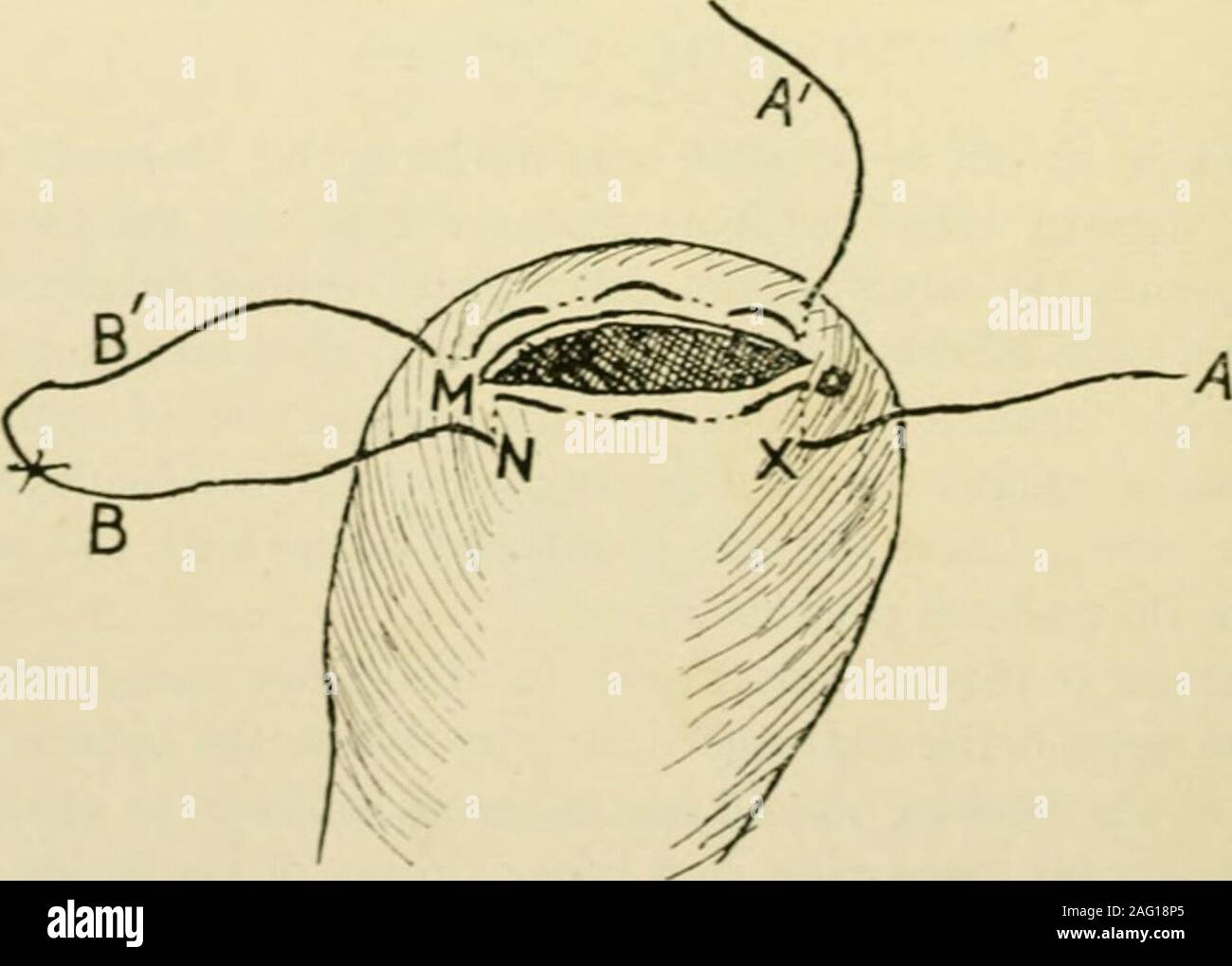 . Manual of operative surgery. with a double revere introduced into ...