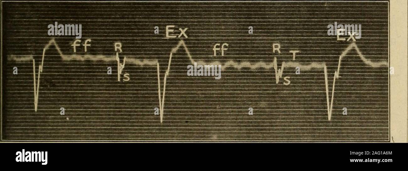 . Medical diagnosis for the student and practitioner. Fig. 257.—Lead I ...
